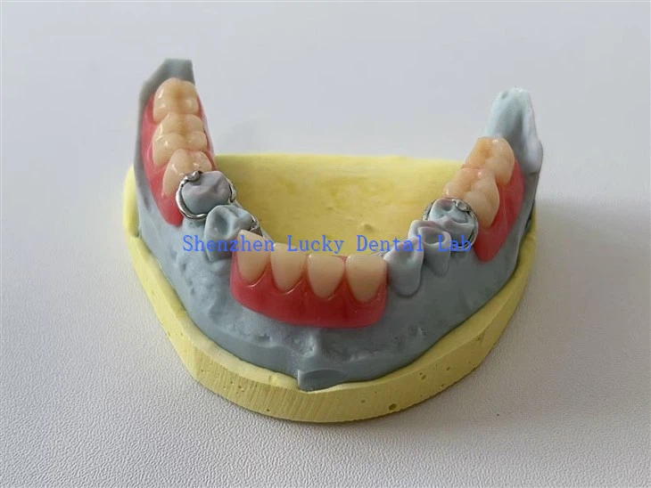China Customized Acrylic Denture with Metal Framework Try in Dental Lab ...